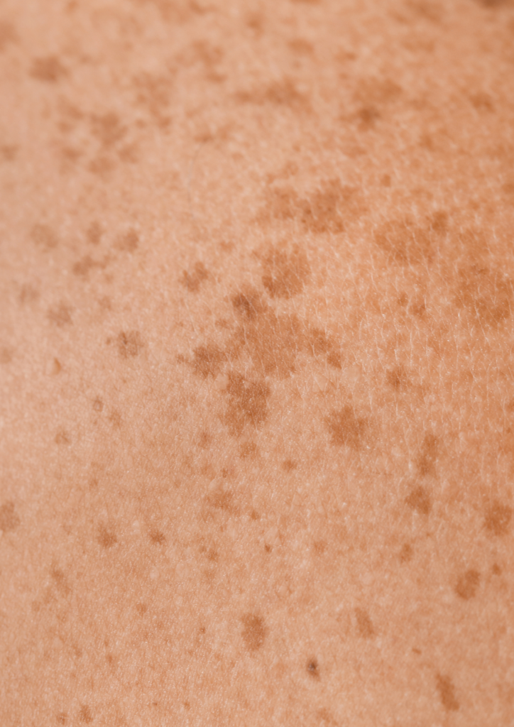 Taches pigmentaires • Docteur Pauline Dicharry